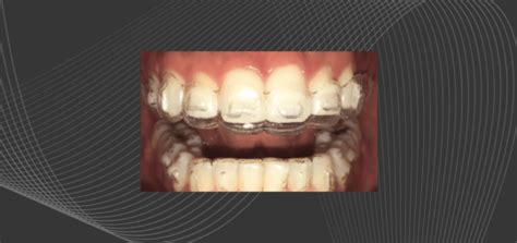 How To Keep Your Aligners Tracking In 5 Minutes Vpro Series
