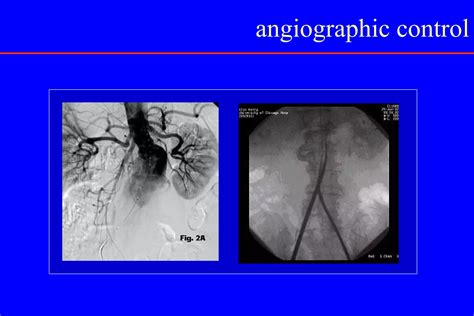 Abdominal Aortic Aneurysm Ppt Abdominal Aortic Aneurysm Ppt