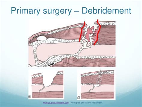 Ppt Open Fractures Principles Of Management Powerpoint Presentation