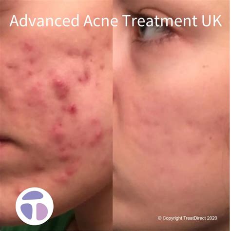 Patient Before And After Photos Treatdirect