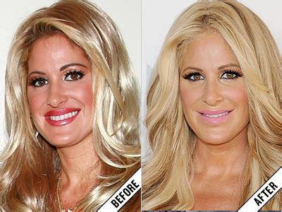 The Most Dramatic Real Housewives Makeovers Celebrity Plastic Surgery