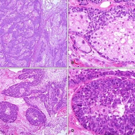 A Pink Well Circumscribed Suprapubic Mass With A Diameter Of 3 Cm