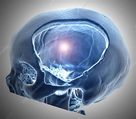 3d Ct Of Hemicraniectomy Stock Image C036 5198 Science Photo Library
