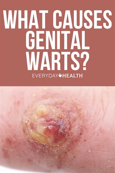 6 Natural Remedies For Warts On Hands Artofit