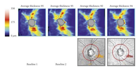 Progressive Thinning Of The Retinal Nerve Fiber Layer Rnfl Guided Download Scientific