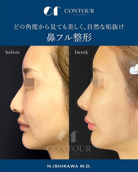 Dr石川菜緒｜コントアクリニック東京｜美容外科 鼻整形 ☜ 他の症例もチェックする🫧 ⁡ ⋆┈┈┈┈┈┈┈┈┈┈┈┈┈┈┈⋆ 【鼻整形