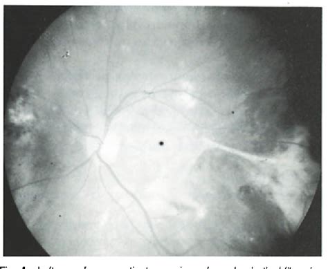 Squamous Blepharitis Semantic Scholar