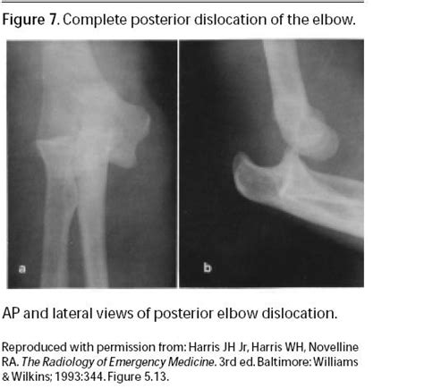 Orthopedic Sports Injuries Off The Sidelines And Into The Emergency