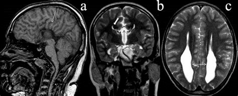 Corpus Callosal Agenesiscomplete Sagittal T1wa And Coronal T2w B