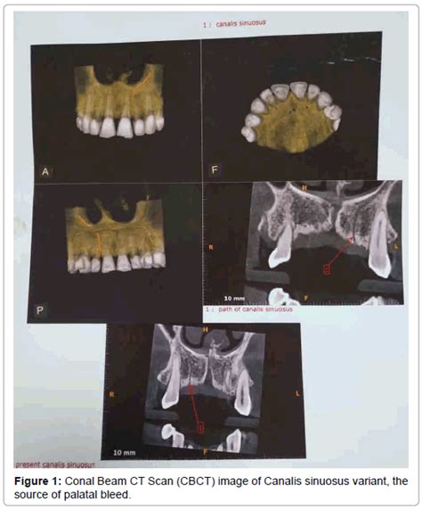 Otolaryngology Open Access Spontaneous Oral Bleeding From Canalis