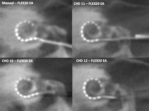 Trials Performed With Our Novel Simple Insertion Tool Using A 20 Mm Ea Download Scientific