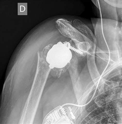 Patient Specific Lateralization Glenoid Offset Implications And Oper