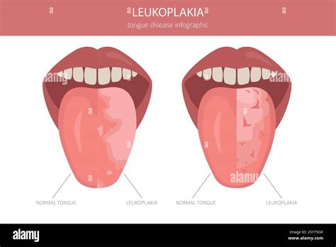 Leukoplakia Tongue Disease Oral Medicine Medical Infographic Design
