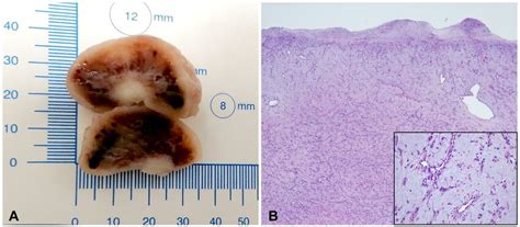 Resected Infundibular Myxoma A Section Of Myxoma Biopsy B