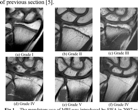 Table 1 From 3d Segmentation And Volumetric Of Growth Plate Of Radius