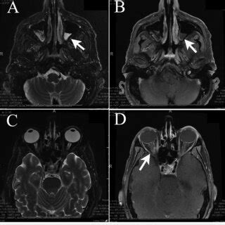 Magnetic Resonance Imaging MRI Of The Orbit Face Neck A Axial T2 MRI