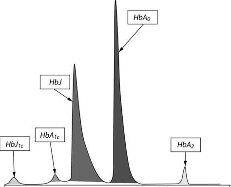Haemoglobin J Baltimore Can Be Detected By Hba1c Electropherogram But