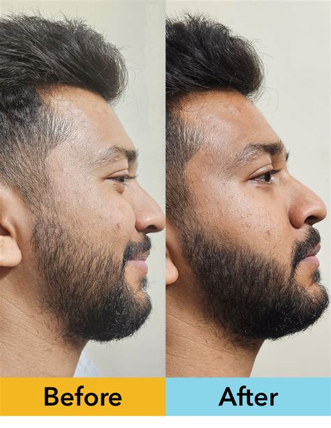 Patchy Beard Fix Instant Solution For Beards Rise For Men