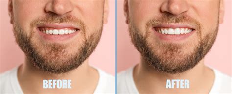 Gum Contouring London Uk Gum Contouring Price Near Me