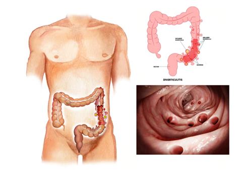 What Exactly Is Diverticulitis Causes Symptoms And Treatment