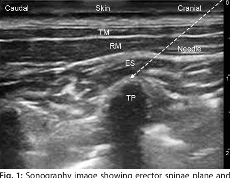 Figure 1 From Bilateral Erector Spinae Plane Block For Breast Augmentation Surgery In