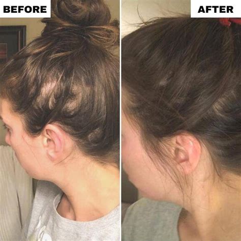 Scalphero™ Smart Scalp Massager Scalp Hero Store