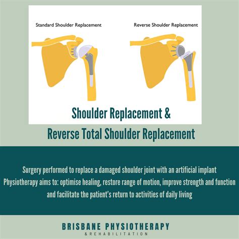 Shoulder Replacementreverse Total Shoulder Replacement Brisbane