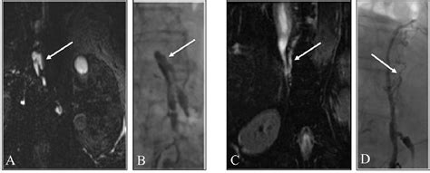 Figure 1 From When Why And How Of Thoracic Duct Embolization