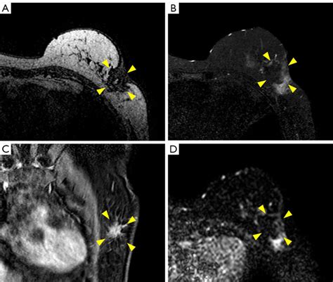 Imaging Findings Of Primary Breast Telangiectatic Osteosarcoma A Case Description Pmc