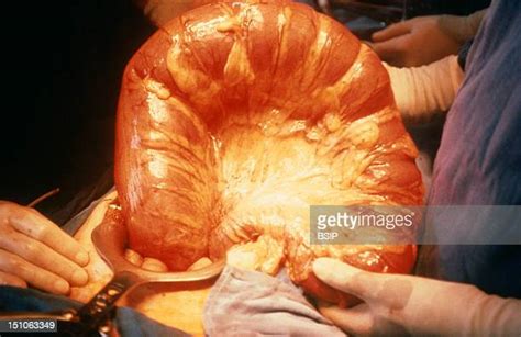 Bowel Obstruction Photos And Premium High Res Pictures Getty Images