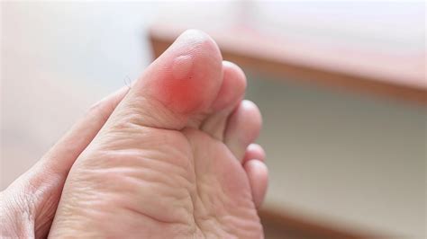 4 Tips For Treating Blisters On Your Feet Goodrx