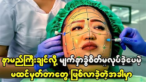 ဒီမင်းသမီးက နာမည်ကြီးချင်လို့ မျက်နှာခွဲစိတ်မှုလုပ်ခဲ့ပေမဲ့ မထင်မှတ်တာတ