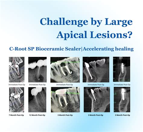 C 根 Sp 锶基生物陶瓷根管封闭剂 C Root Dental Medical