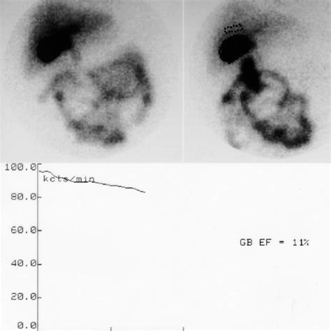 Gallbladder Ejection Fraction In Case 2 Following Compounded Sincalide