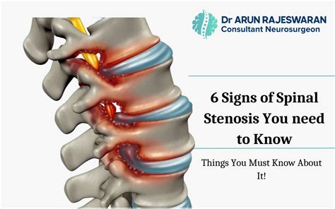 6 Signs Of Spinal Stenosis You Need To Know