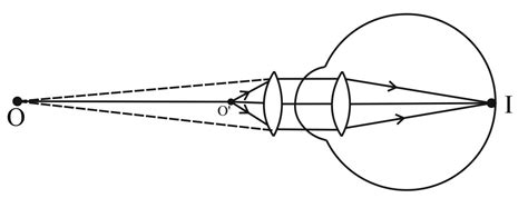 What Is Hypermetropia Give Its Causes Explain With The Help Of A