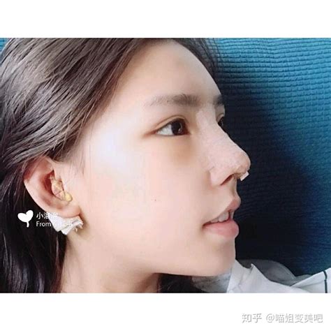来自粉丝的隆鼻分享 知乎