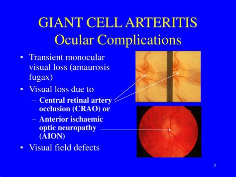 Ppt Giant Cell Arteritis Temporal Or Cranial Arteritis Powerpoint Presentation Id 353988
