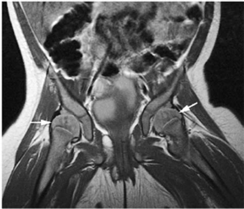 Marrow Imaging Musculoskeletal Key