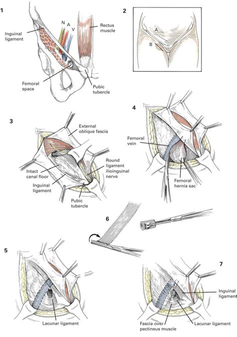 Femoral Hernia Repair Hospital For Hernia Surgery In Bangalore