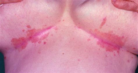 Intertrigo O Que é Sintomas Causas E Tratamento Mundoboaforma