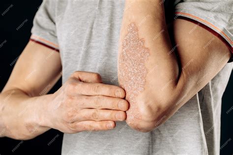 Premium Photo Acute Psoriasis On The Elbows Is An Autoimmune