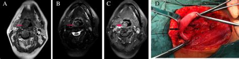 Magnetic Resonance Imaging Revealed A 1 3 × 2 2 Cm Mass In The Right