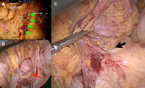 Intraoperative Pictures In Case 2 A Petersens Defect Closure At The