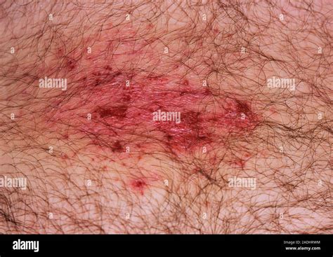 Allergic Contact Dermatitis Acd Inflamed And Itchy Rash Around A 20