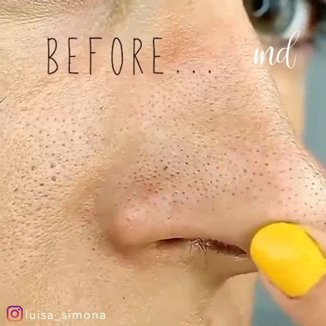 Acne Face Ideas To Save Today Beauty Hacks Skin Care Beauty Care And More