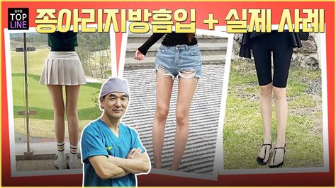 종아리지방흡입 [실제사례] 전후 사례 분석 Youtube