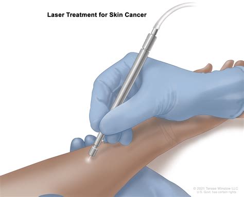 Definition Of Laser Therapy NCI Dictionary Of Cancer Terms NCI
