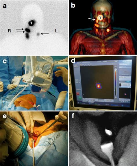 Combined Preoperative Lymphatic Mapping And Intraoperative Radio And