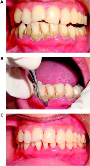 Supra Gingival Hand Scaling Pre And Immediate Post Operative A